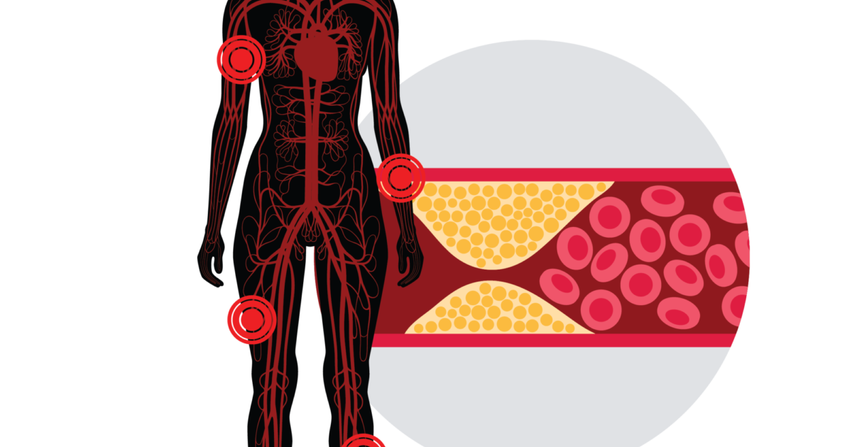 Peripheral artery disease (PAD) • Heart Research Institute