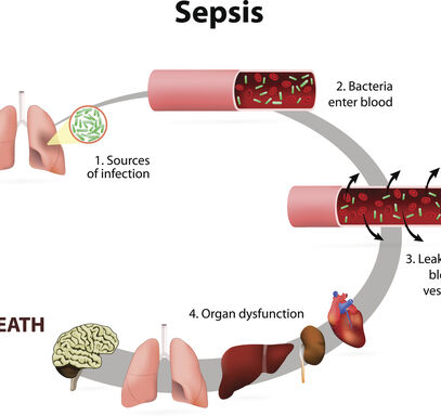 Understanding sepsis and heart impact • Heart Research Institute