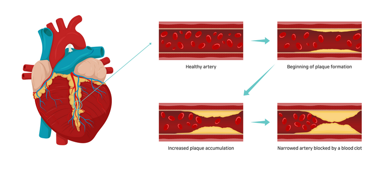 The 12 most common heart and cardiovascular conditions • HRI