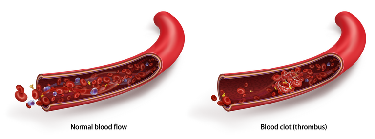 Thrombosis: symptoms and causes • Heart Research Institute