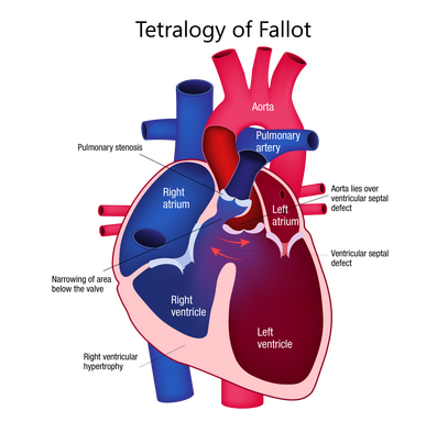 Congenital heart disease • Heart Research Institute